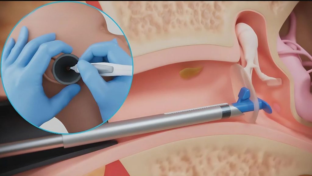 Traditional Vs. Hummingbird Ear Tubes: Key Differences