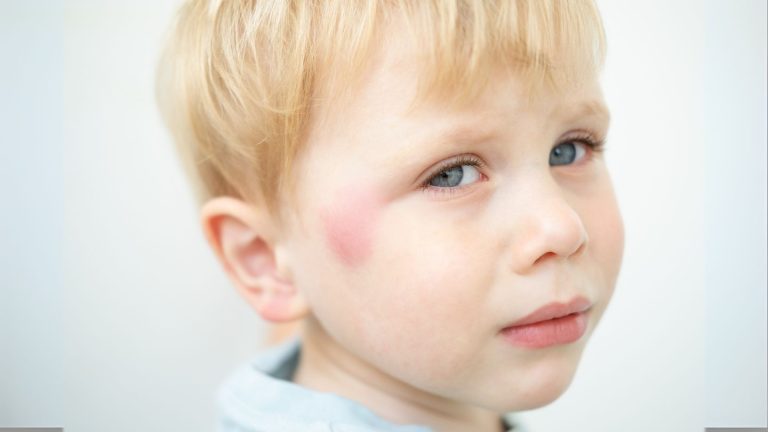 Facial Masses in Children: Causes, Types & Treatment